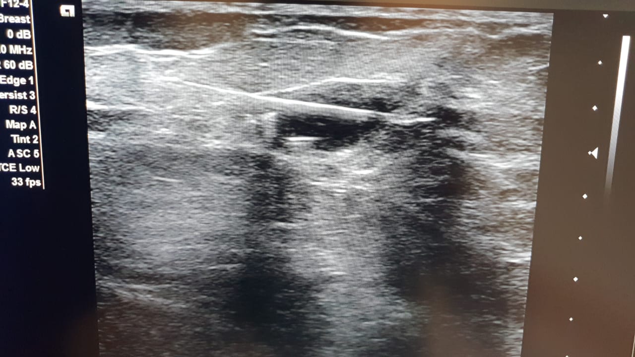 Breast Wire Localization Placement - Northern Interventional Radiology ...