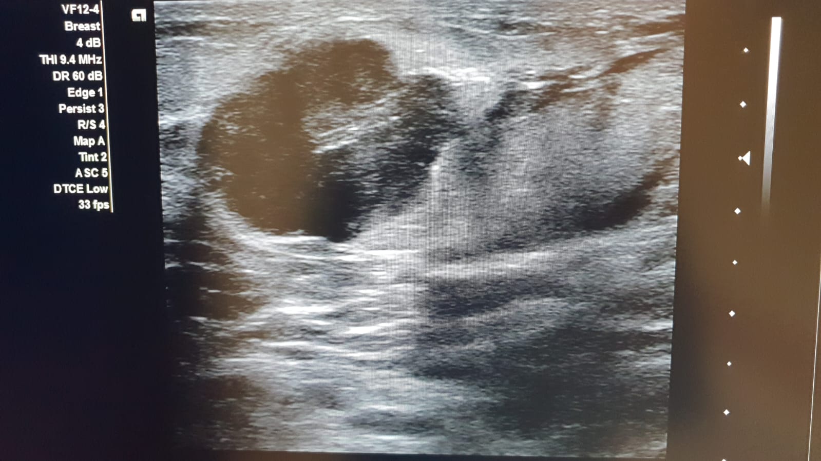 Breast Tumor Marker Clip Placement - Northern Interventional Radiology ...