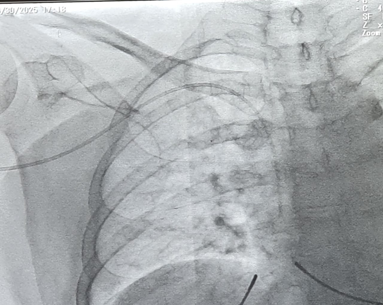 PICC Line - Northern Interventional Radiology Services